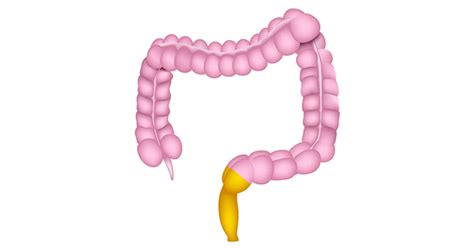 Ulcerative Proctitis Ulcerative Colitis Ibdrelief