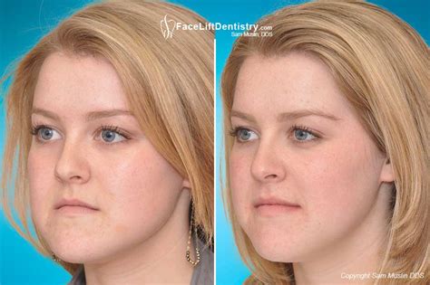 How To Make My Face Thinner Without Makeup Saubhaya Makeup