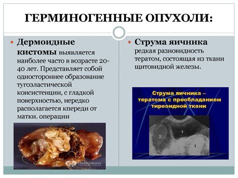 Опухоли яичников презентация онлайн