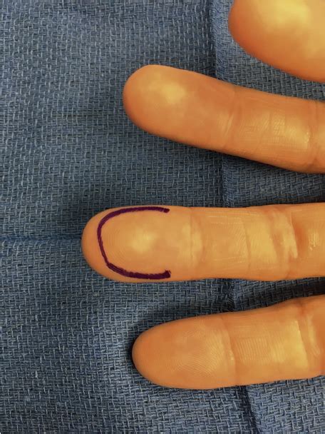 86 Felon Plastic Surgery Key