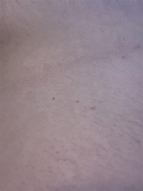 Bug Bites Or An Allergic Reaction Rbugbites