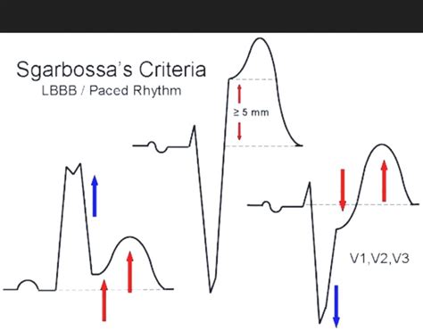 Sgarbossa Criteria In Bundle Branch Blocks And Paced Rhythm
