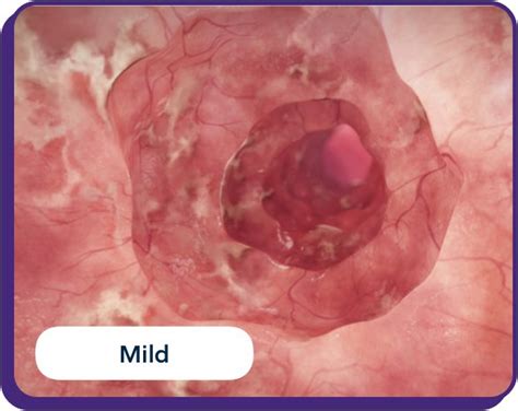 Ulcerative Colitis Severity And Progression