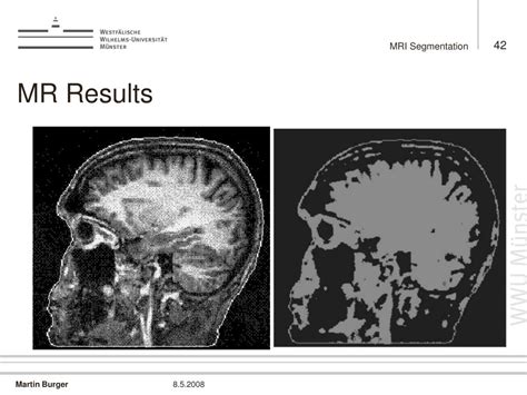ppt level set methods for imaging and application to mri segmentation