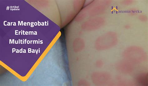 Cara Mengobati Eritema Multiformis Pada Bayi Hanania Serka