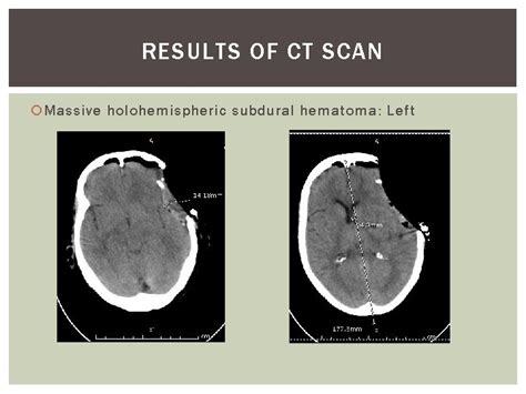 Mannitol And Hypertonic Saline In Subdural Hematoma February