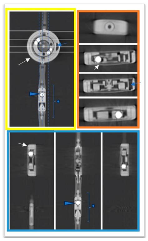 Three Dimensional Visualization Of Shunt Valves With Photon Counting Ct