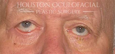 Houston Ectropion Repair Before And After Photos Baytown Plastic Surgery Photo Gallery Dr