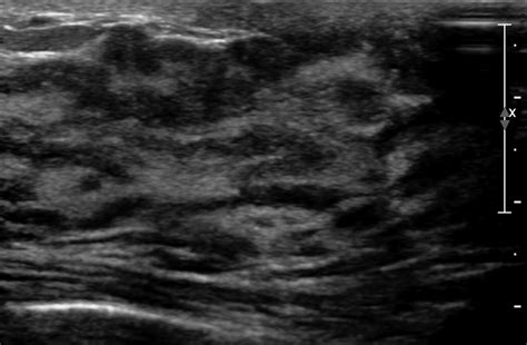 Breast Ultrasound While Breastfeeding At Bob Bormann Blog
