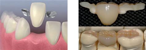 Puente Dental De 4 Unidades All On 4 Y All On 6 Implantes Dentales