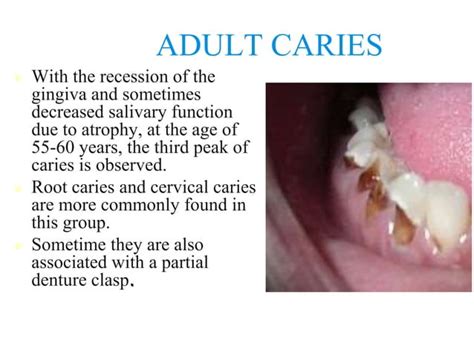 Dental Caries Classification Ppt