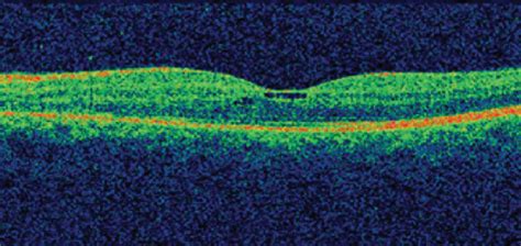 A L Serial Oct Scans Showing The Evolution Of Maculopathy Obtained Download Scientific