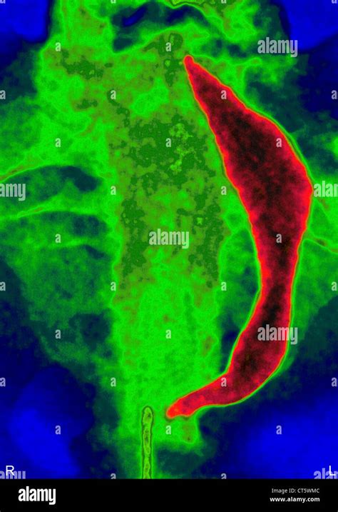 Fibrome utérin Banque de photographies et dimages à haute résolution Alamy