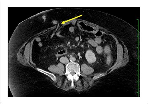 Transverse Computed Tomography Angiogram Of The Abdomen Demonstrates Download Scientific