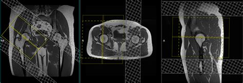 Mri Arthrogram Hip Protocol And Planning Indications For Mri