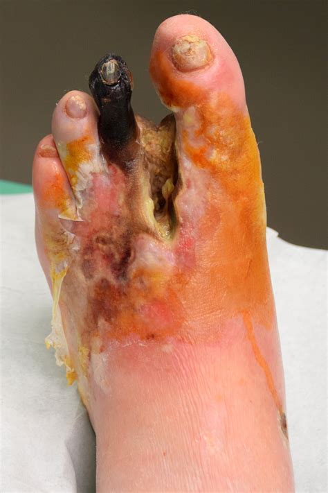 How Good Are Clinicians In Predicting The Presence Of Pseudomonas Spp