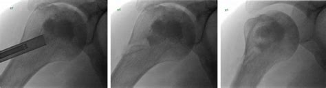 Right Shoulder Beach Chair Position Intraoperative Fluoroscopic