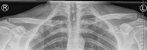 Acj Dislocation The Bone School