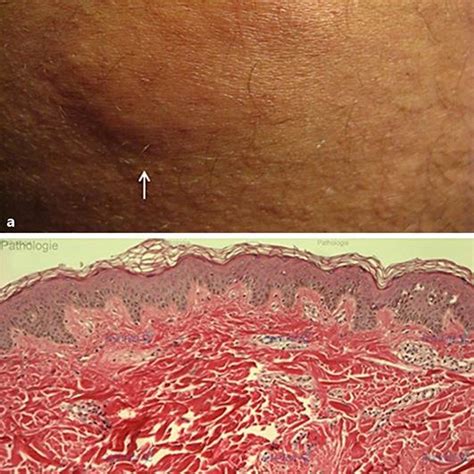 A Clinical Photograph Of A Shagreen Patch Arrow B Histopathological