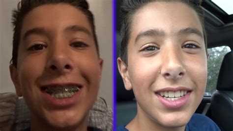At Home Braces Gone Wrong At Sherry Ramos Blog