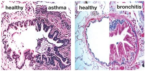 Chronic Bronchitis Histology