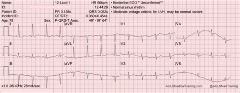 Types Of Ecg Artifacts Understanding Interference