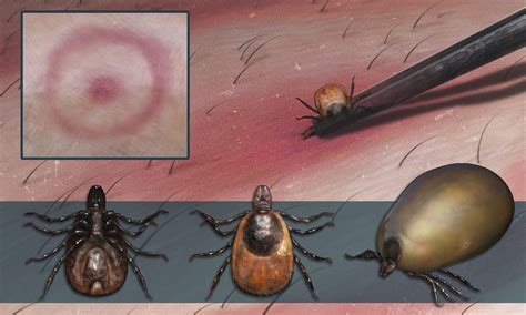 Travellers Warned Of New Virus Outbreak With Risk Of Deadly Brain