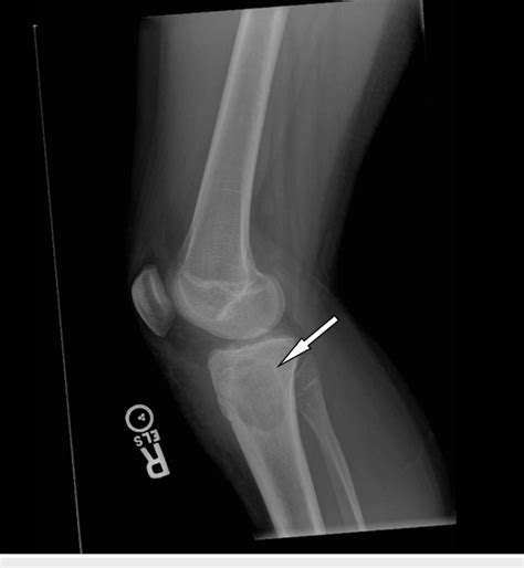 Lateral Radiograph With Arrow Demonstrating A Lucency In The Proximal Download Scientific