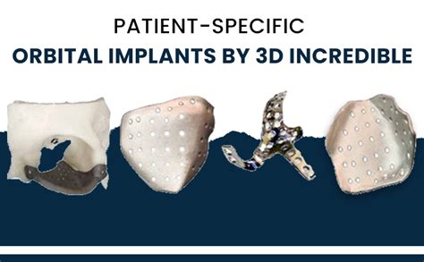 Patient Specific Orbital Implants By 3d Incredible 3dincredible
