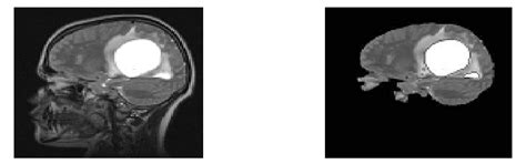 Medical Image Segmentation A Original Image And B Tumour Segmented