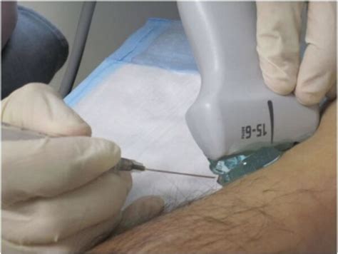 Distal Tibiofibular Joint Injection Wikism Sports Medicine Wiki