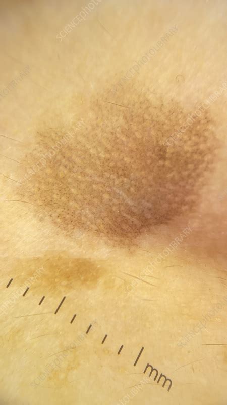 Lichenoid Keratosis Dermoscopy Stock Image C060 4266 Science