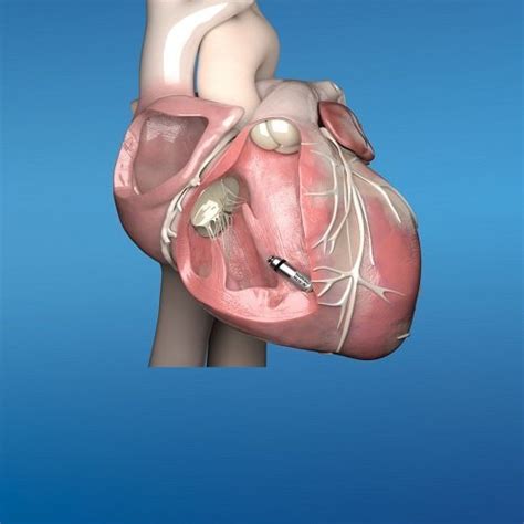 Medtronic Micra Av Pacemaker Heart Pacemaker Artificial Pacemaker Artificial Cardiac