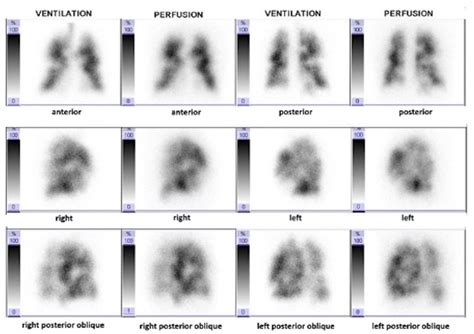 Planar Vq Scan Showing Multiple Perfusion Defects Matched With