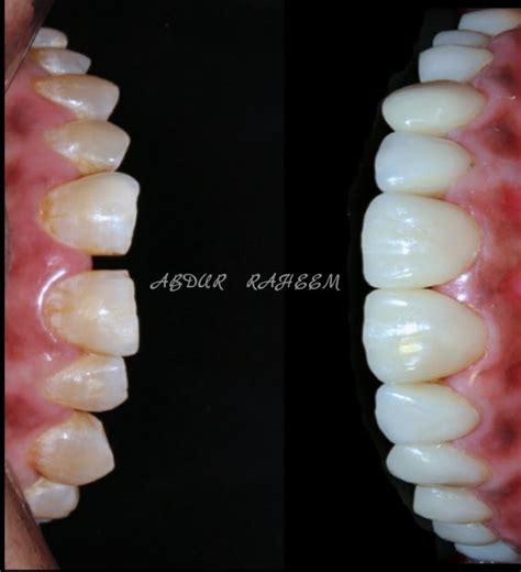 A Case Of Occlusal Interference And Kareem Dental Clinic