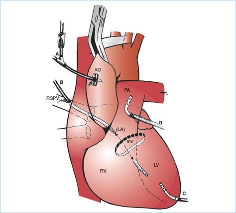 Cardiopulmonary Bypass Cannulation