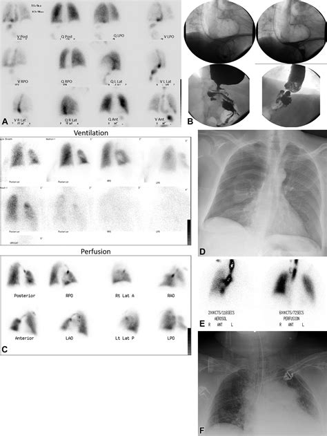 Ventilation Perfusion Scan A Primer For Practicing Radiologists Radiographics