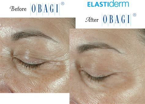 Obagi® Before And After Pictures Micki Ly M D Maui Dermatologist