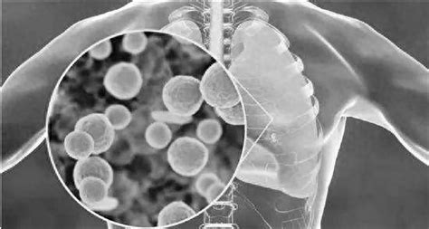 上周全国现401起流感样病例暴发疫情！什么人群易“白肺”？警惕—— 检查 患者 肺部