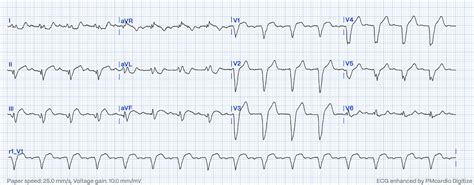Sgarbossa Criteria Advanced Cardiac Diagnosis Pmcardio