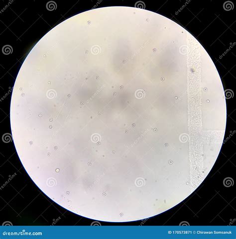 Dysmorphic Red Blood Cells In Urine Sediment Stock Image Image Of Healthy Micro 170573871