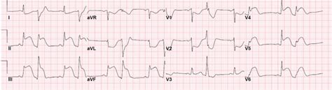 Inferior Stemi Electrocardiogram In A Young Postpartum Female With