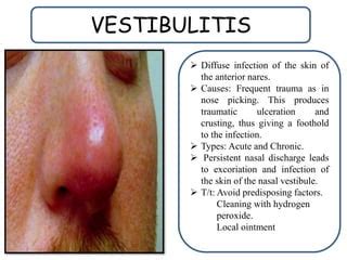 Nasal Vestibular Furunculosis