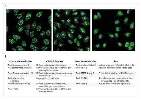 Scleroderma Nejm