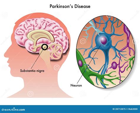 Parkinson S Disease Stock Vector Illustration Of Protein 28712875