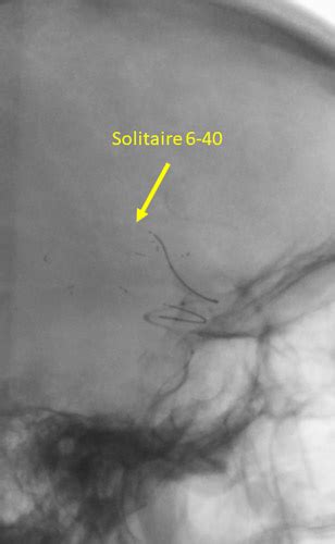 Solitaire 3x20 And 6x40 In Simultaneous 2 Branch Occlusions With Tici