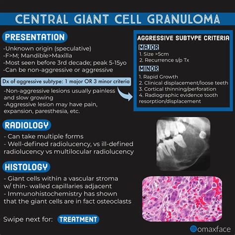 Central Giant Cell Granuloma Histology