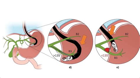 Eus Guided Hepaticogastrostomy Practical Tips And Tricks Youtube