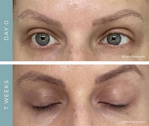 Eyebrow Tinting During Chemo At Josiah Perez Blog