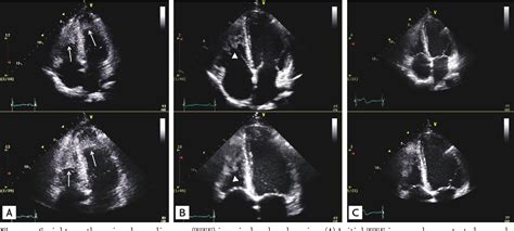 Figure 1 From Loeffler Endocarditis In Chronic Eosinophilic Leukemia